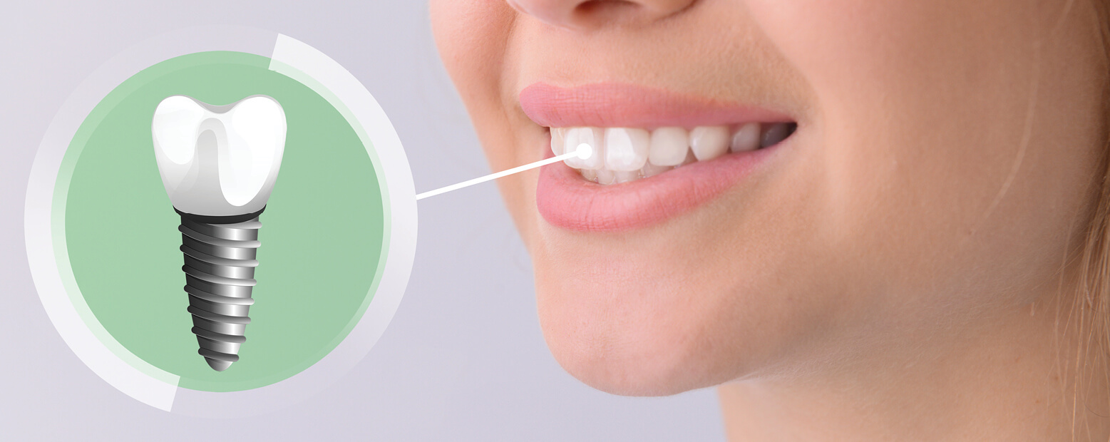 Dental Implants and Bone Grafts - Ultra Smile DentalSpa